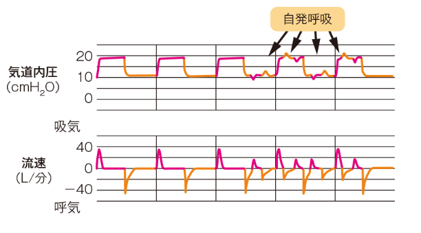 換気モード〜BIPAP(Biphasic Positive Airway Pressure:二相性陽圧換気)とは〜 | 広く浅く暮らすCE